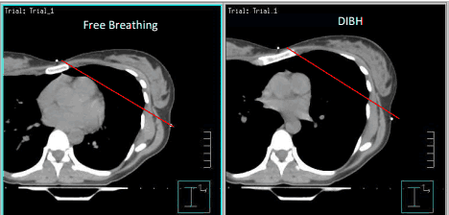 Deep Inspiratory Breath-Hold | Northwestern Medicine