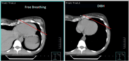 Deep Inspiratory Breath-Hold | Northwestern Medicine