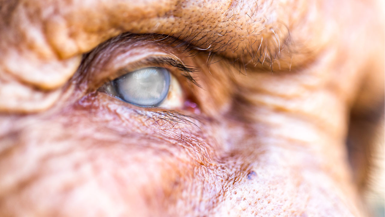 What Are Cataracts? | Northwestern Medicine