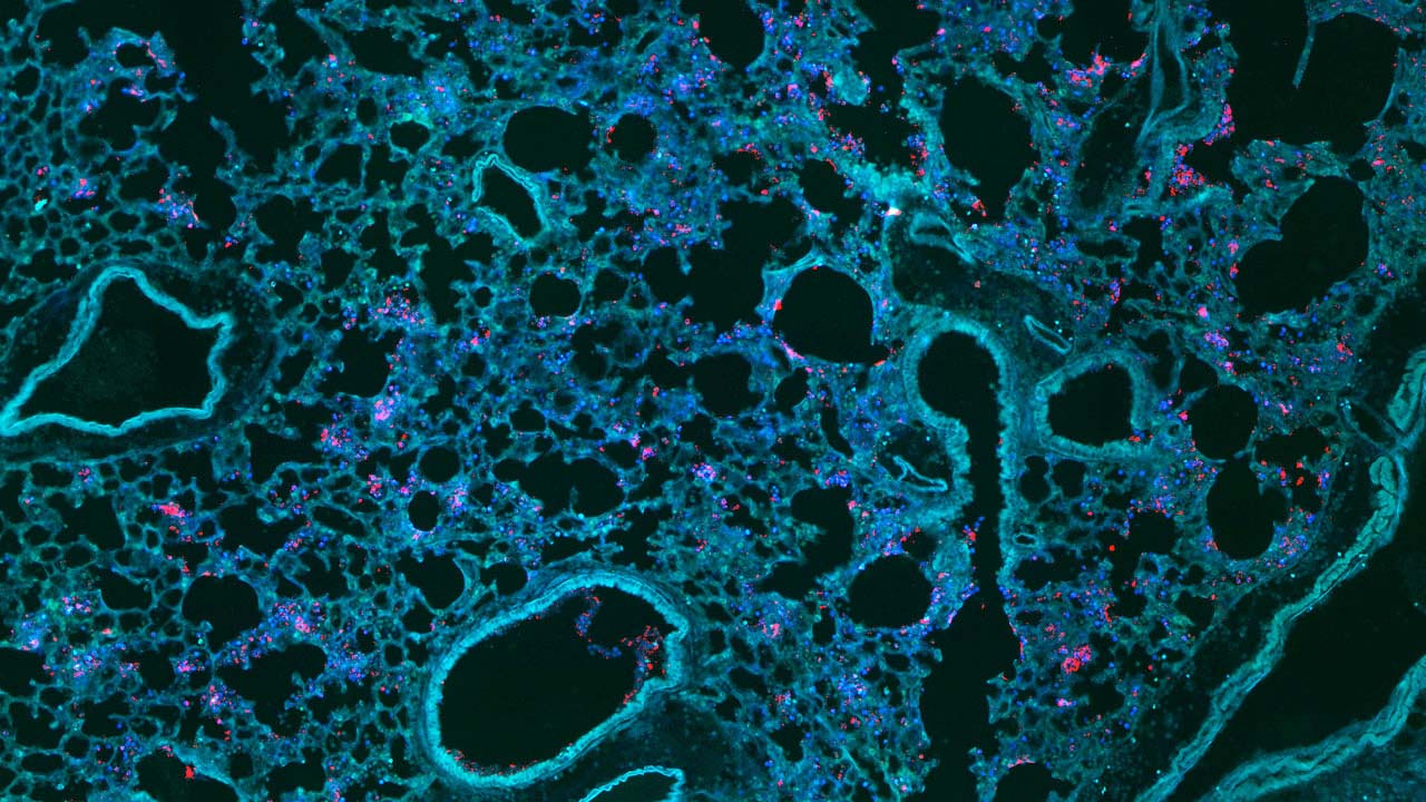 How Pneumonia Spreads to the Bloodstream | Northwestern Medicine