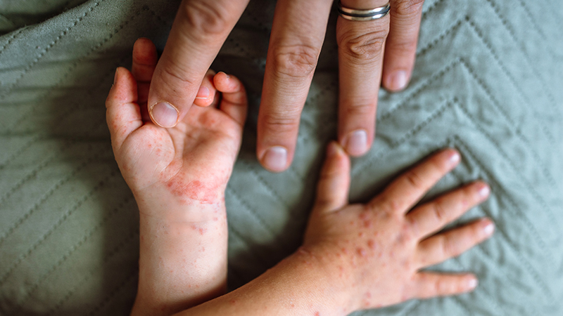 A Parent’s Guide to Hand, Foot and Mouth Disease | Northwestern Medicine