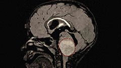 Skull Base Tumors Symptoms | Northwestern Medicine